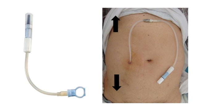 CAPD Catheters.pptx