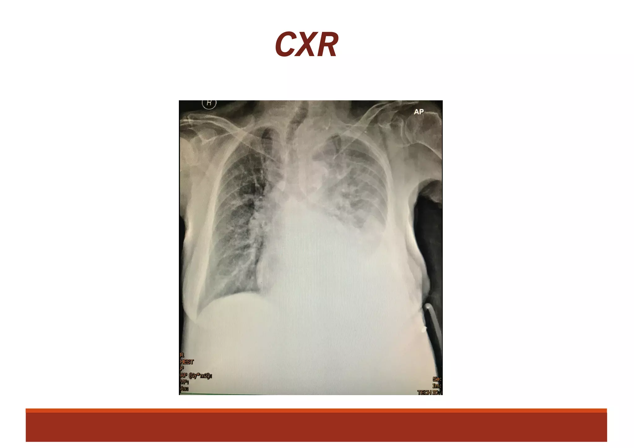 Peritoneal Dialysis catheter complication CAPD Chaken 2017 | PPT