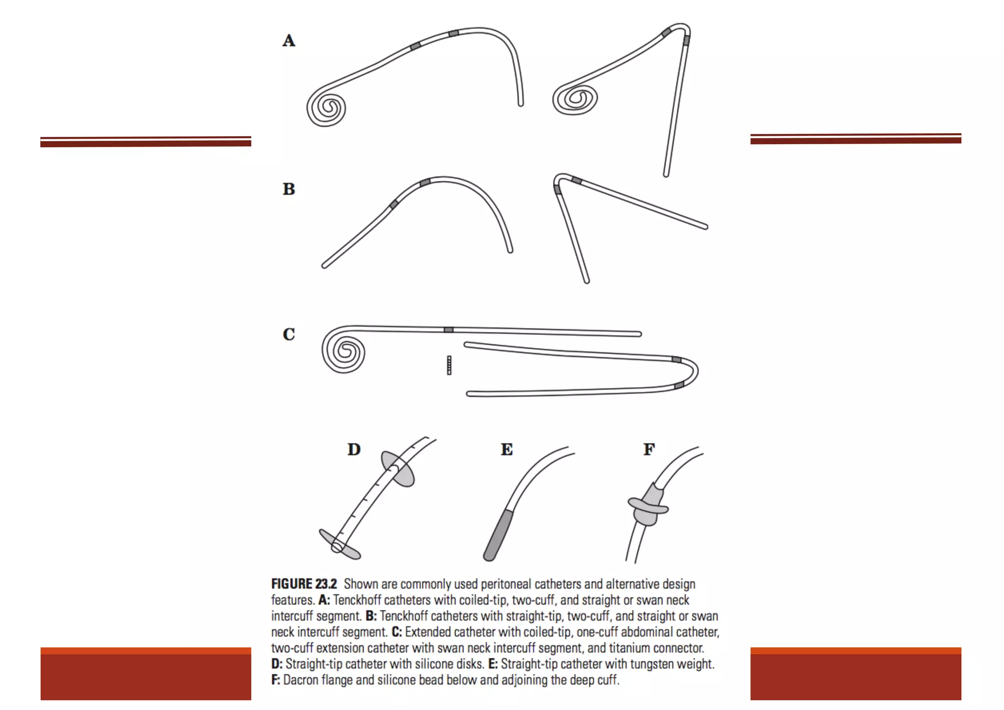 Peritoneal Dialysis catheter complication CAPD Chaken 2017 | PPT