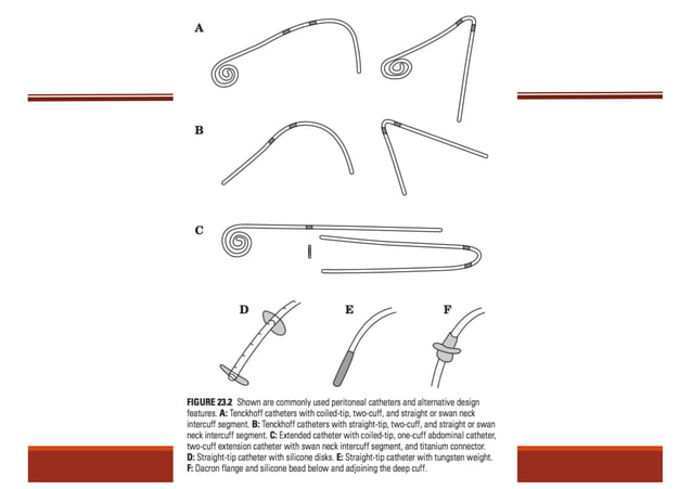 Peritoneal Dialysis catheter complication CAPD Chaken 2017 | PPT