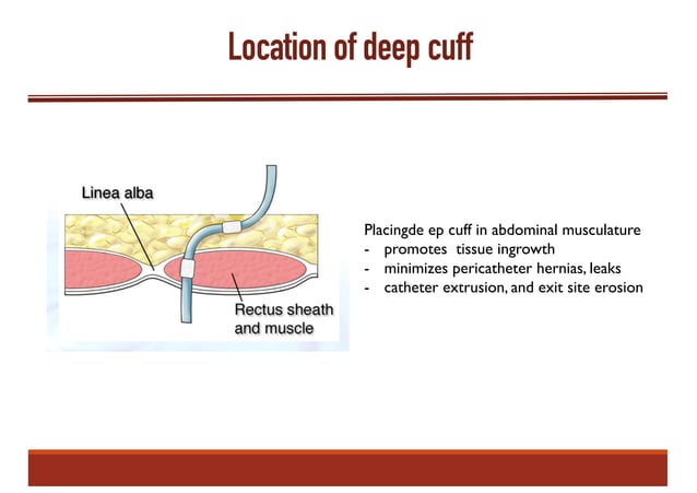 Peritoneal Dialysis catheter complication CAPD Chaken 2017 | PPT