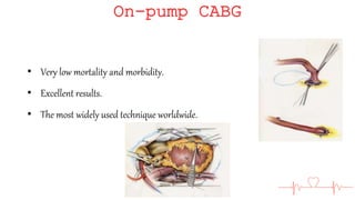 CABG | PPTX