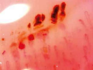 capillaroscopy | PPTX