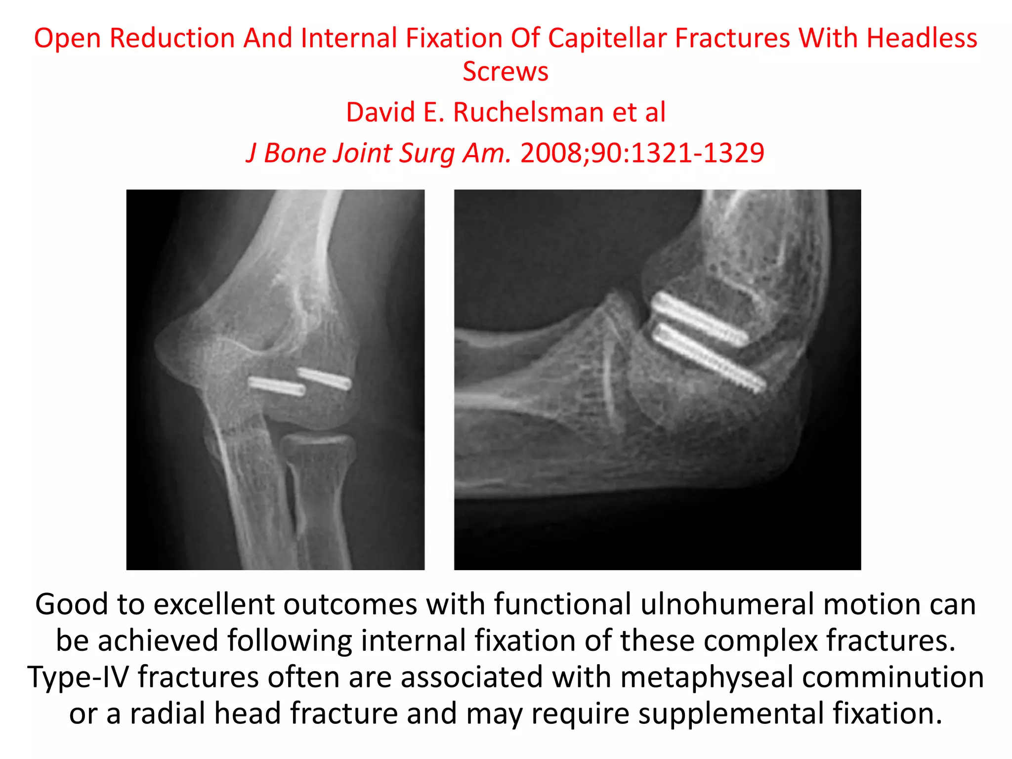 Capitellum fractures | PPTX