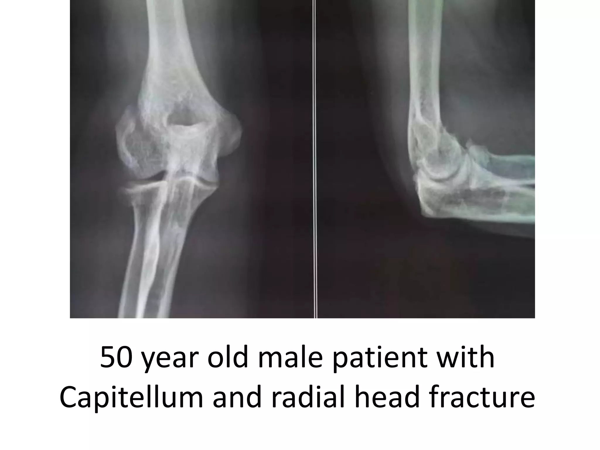 Capitellum fractures | PPTX