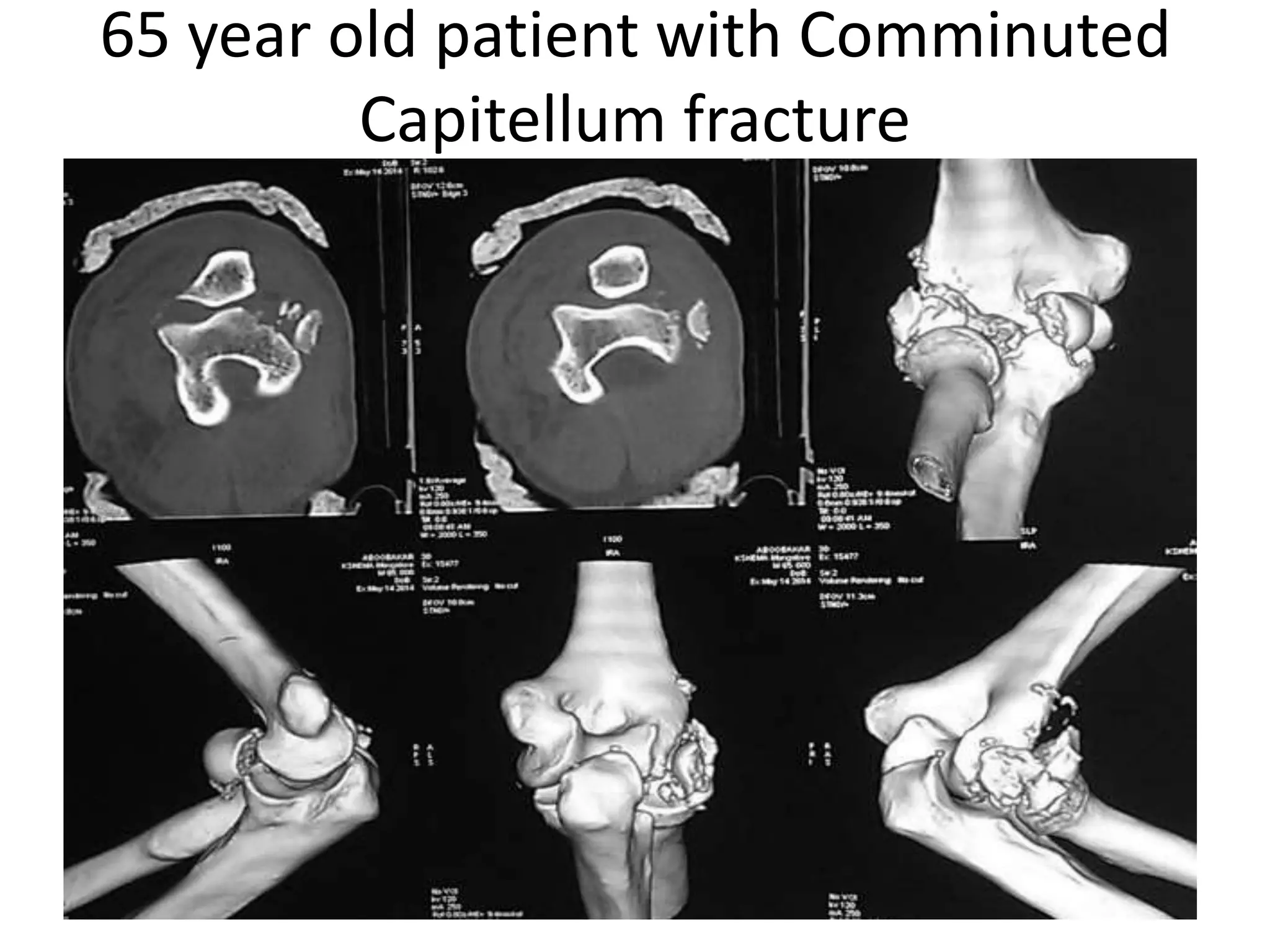 Capitellum fractures | PPTX