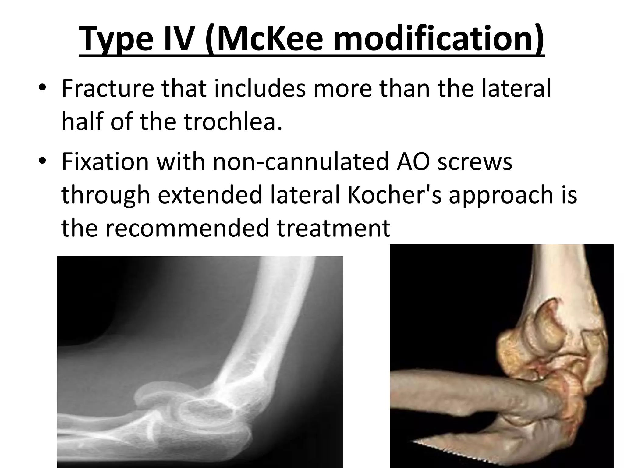 Capitellum fractures | PPTX
