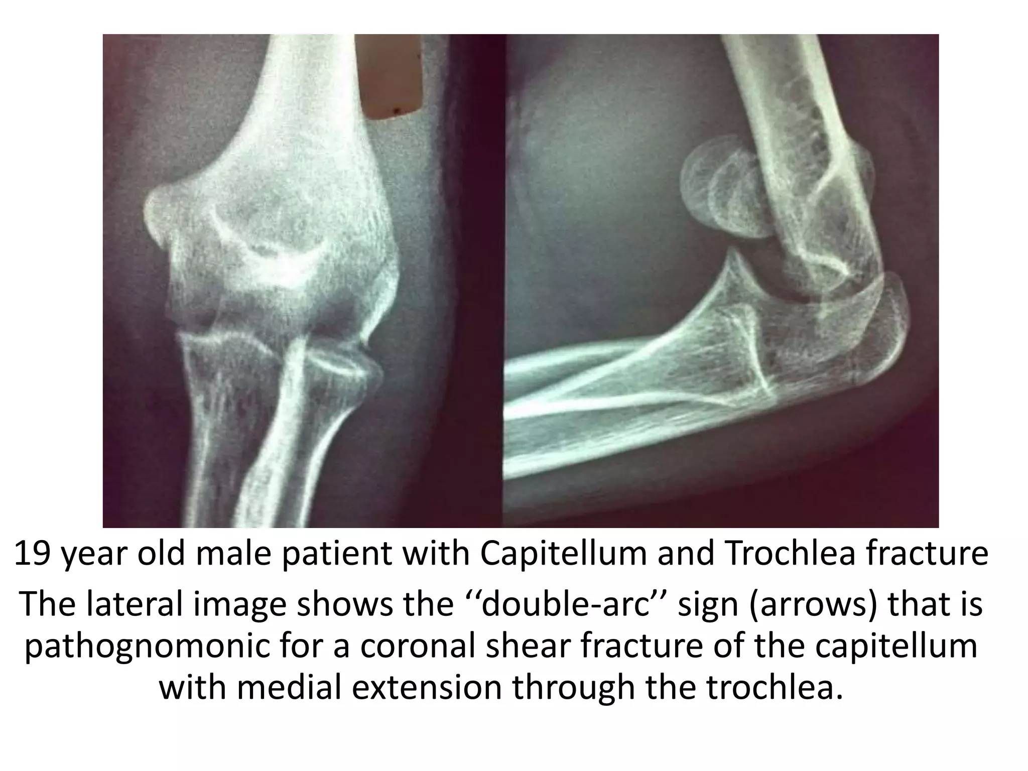 Capitellum fractures | PPTX