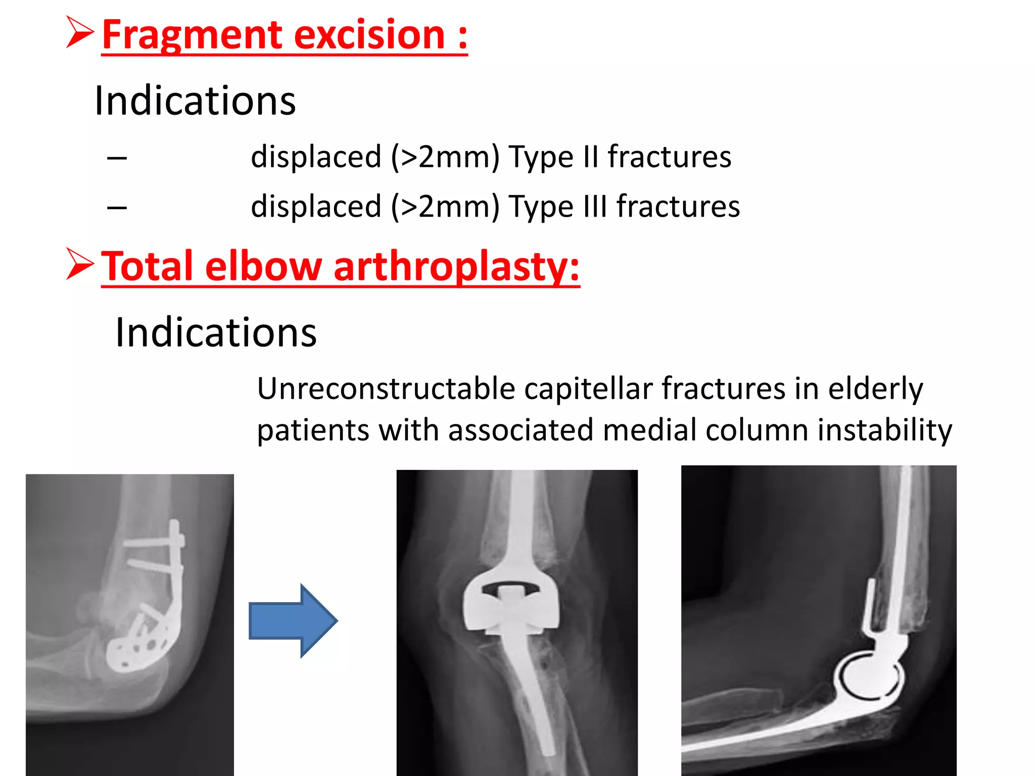 Capitellum fractures | PPTX