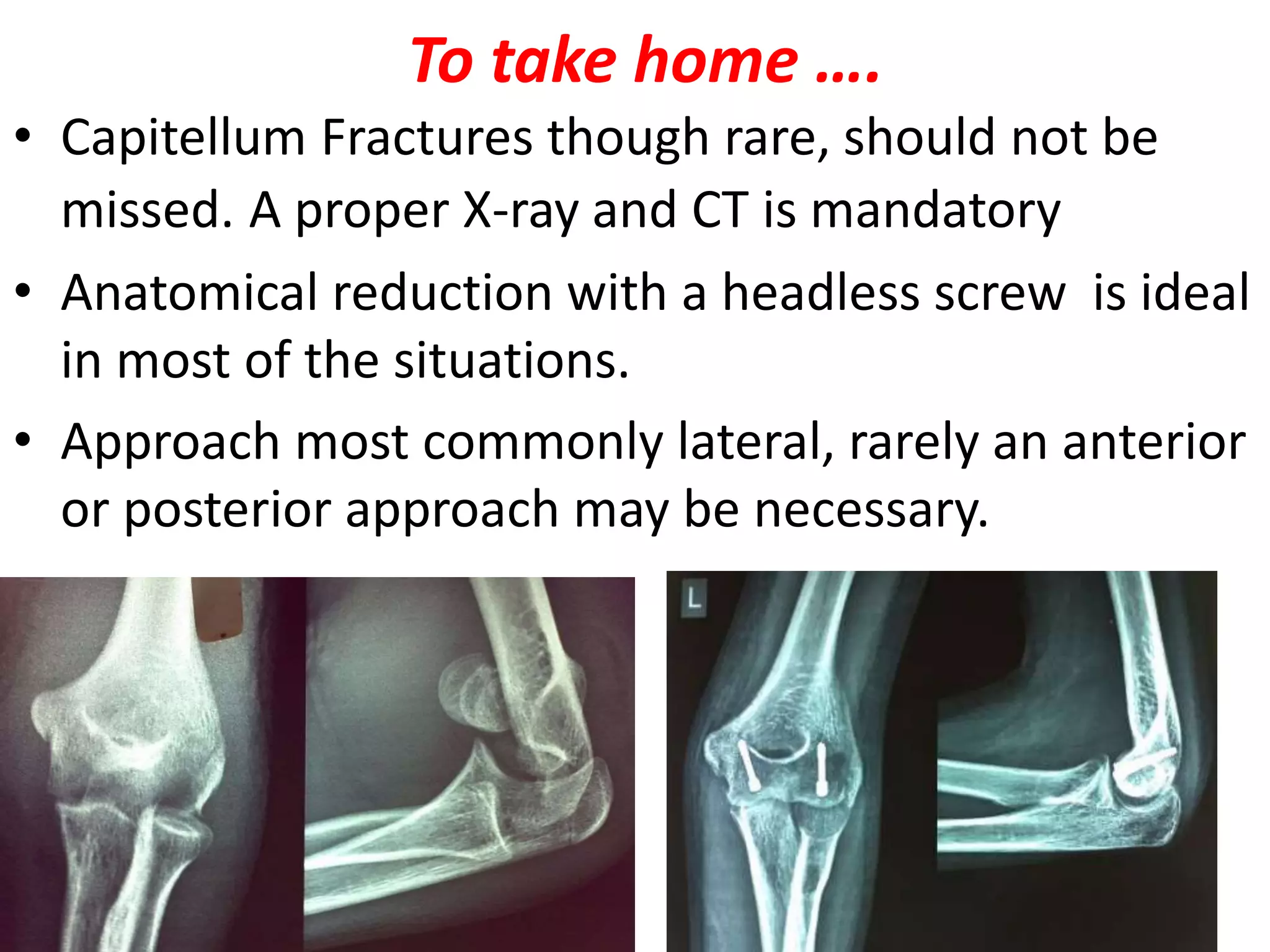 Capitellum fractures | PPTX