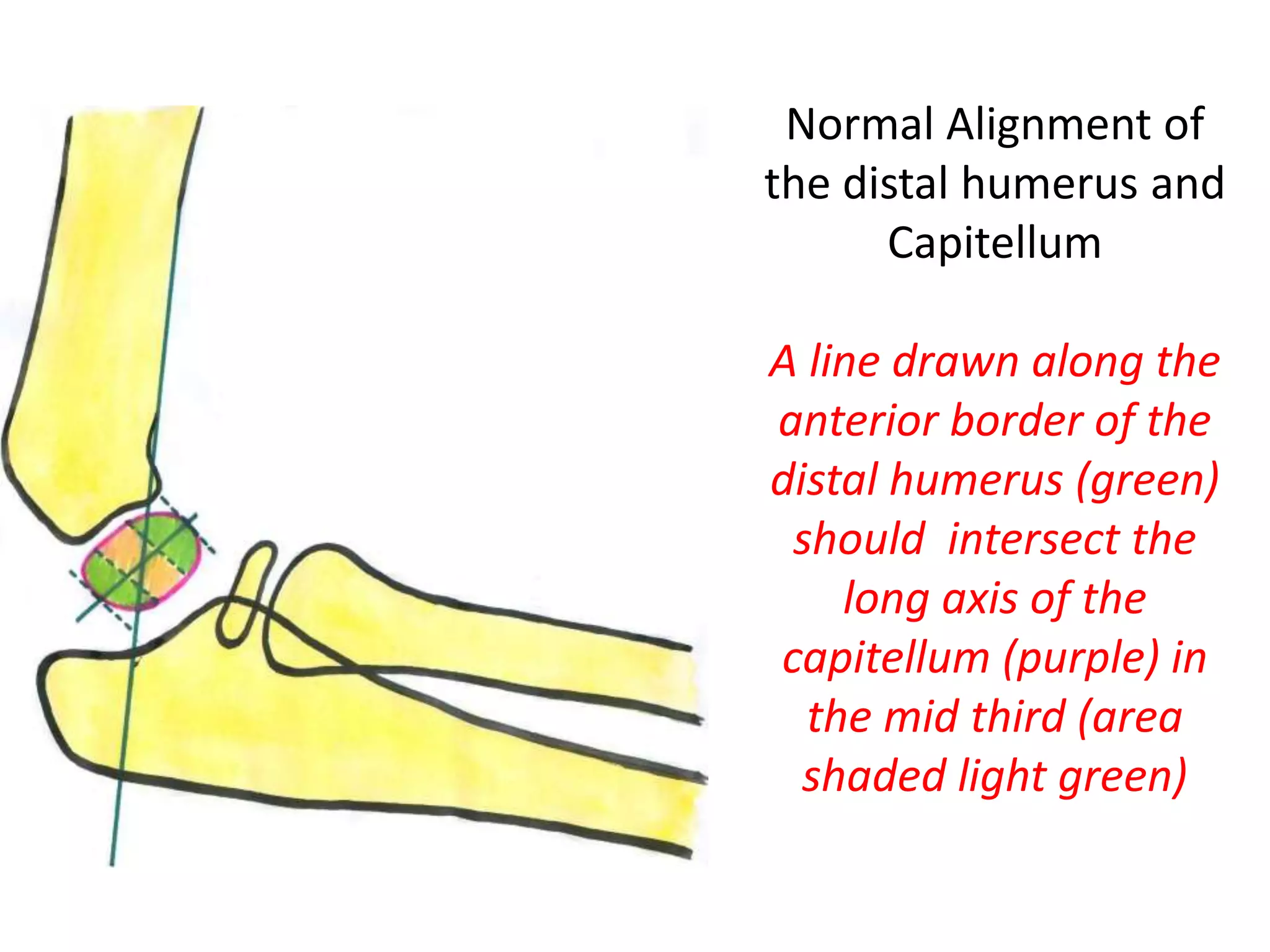 Capitellum fractures | PPTX