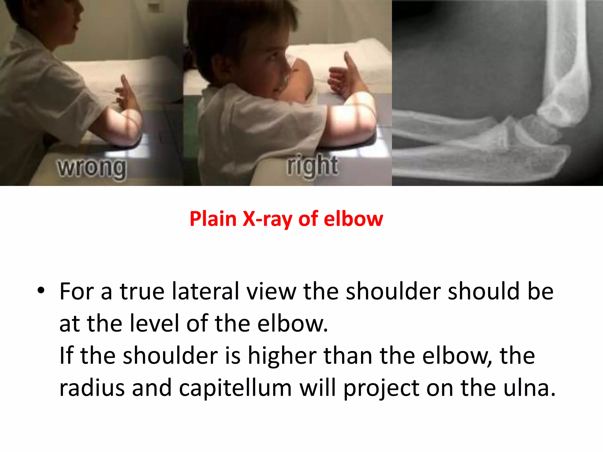 Capitellum fractures | PPTX