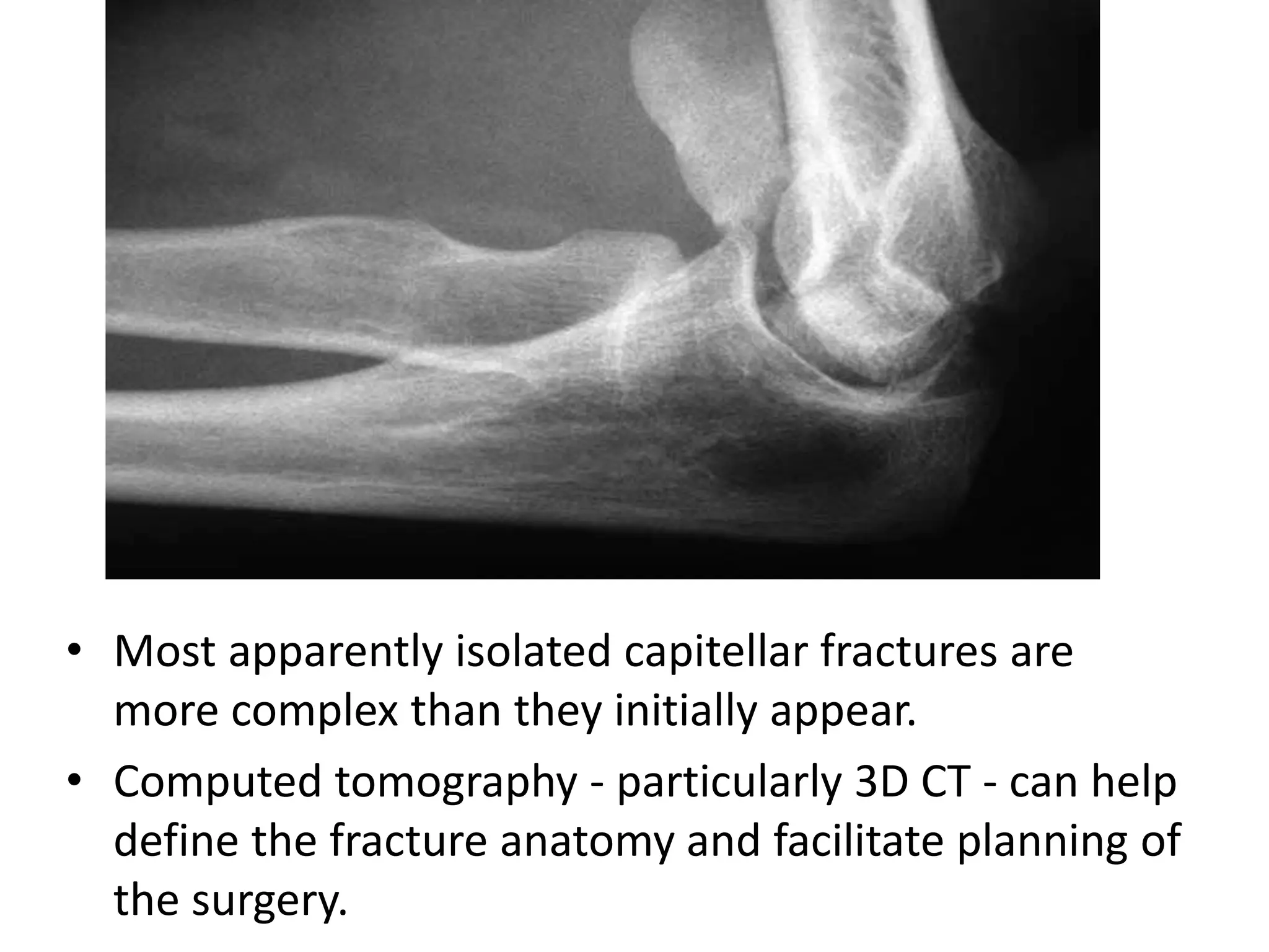 Capitellum fractures | PPTX