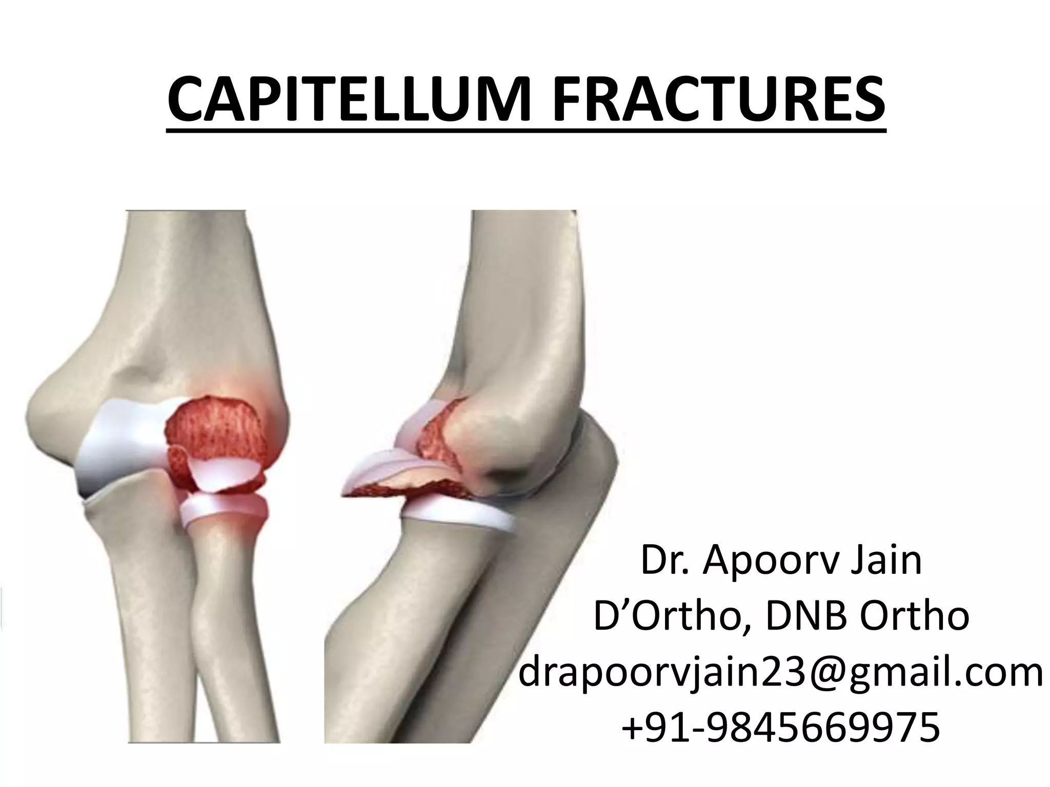 Capitellum fractures | PPT