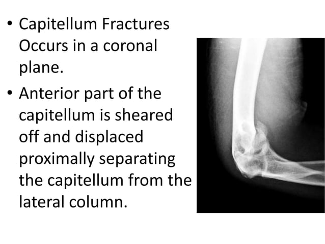 Capitellum fractures | PPTX | Death, Injury, or Military Conflict ...