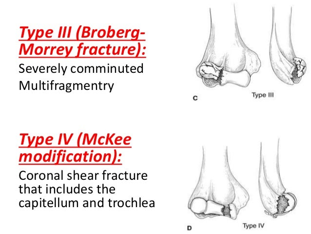 Capitellum fractures