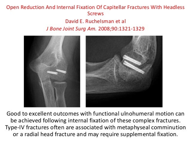 Capitellum fractures