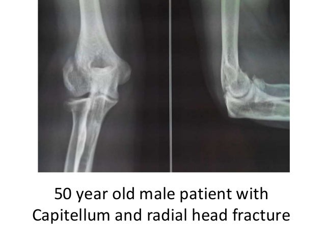 Capitellum fractures
