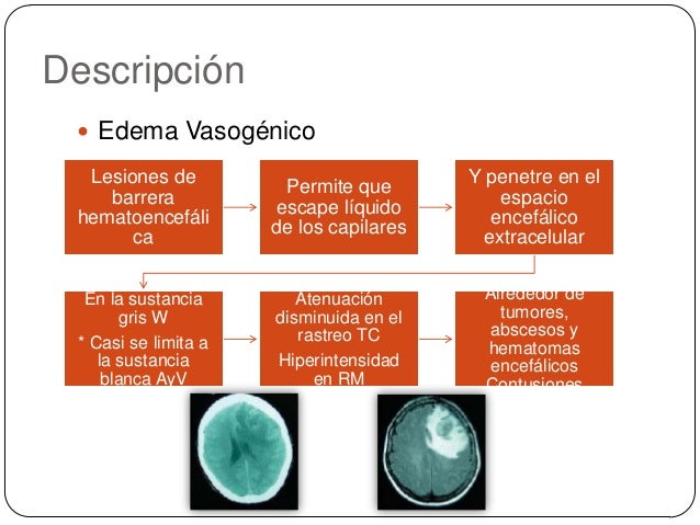 Edema cerebral y TCE