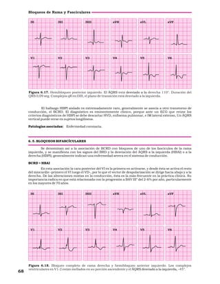 Curso ECG Intramed Capitulo 6 | PDF