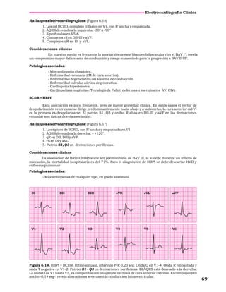 Curso ECG Intramed Capitulo 6 | PDF