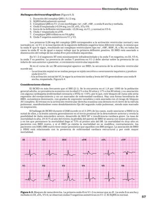 Curso ECG Intramed Capitulo 6 | PDF