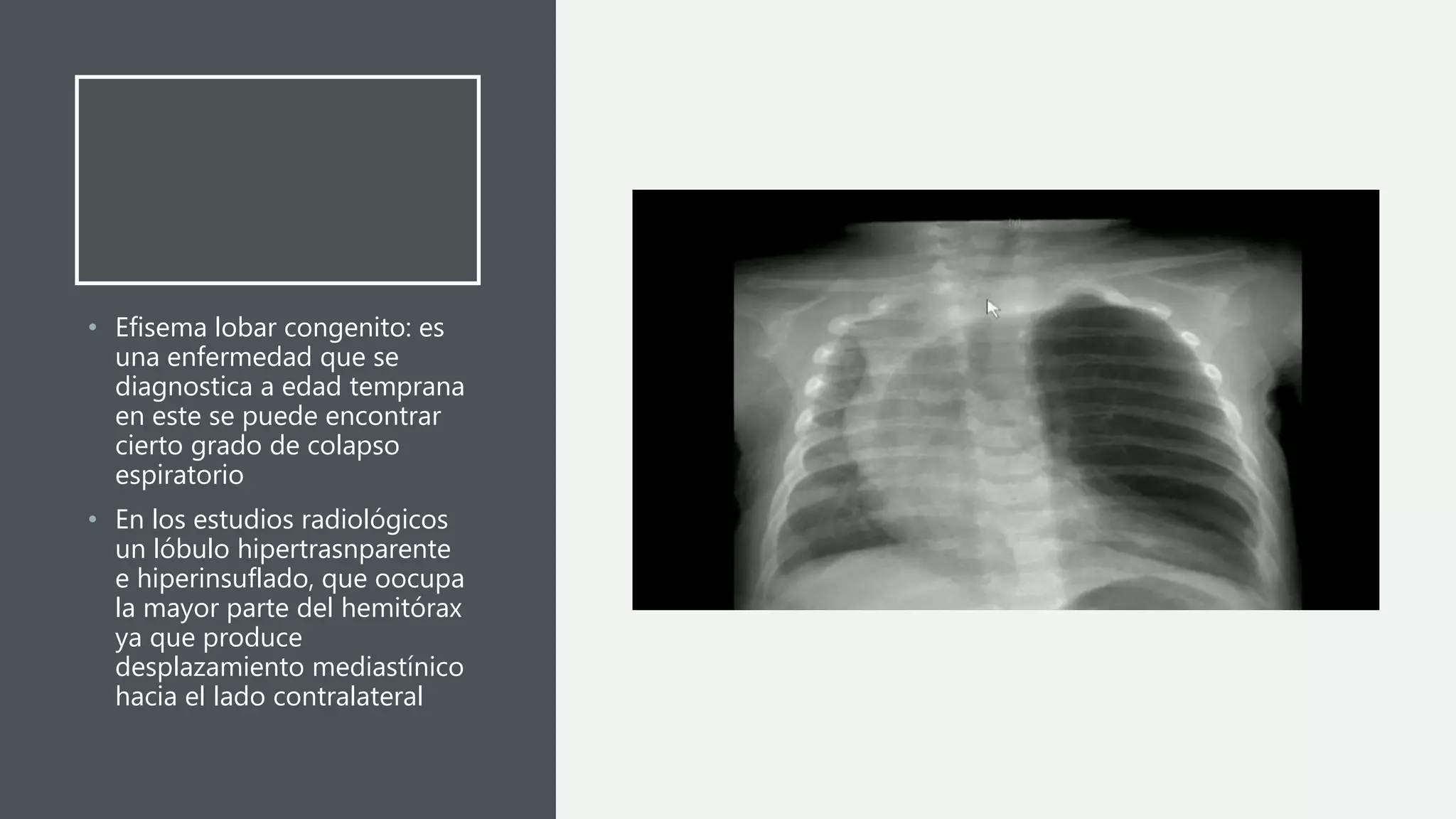 Pedrosa Radiologia e imagenologia El torax; hiperclaridad pulmonar ...