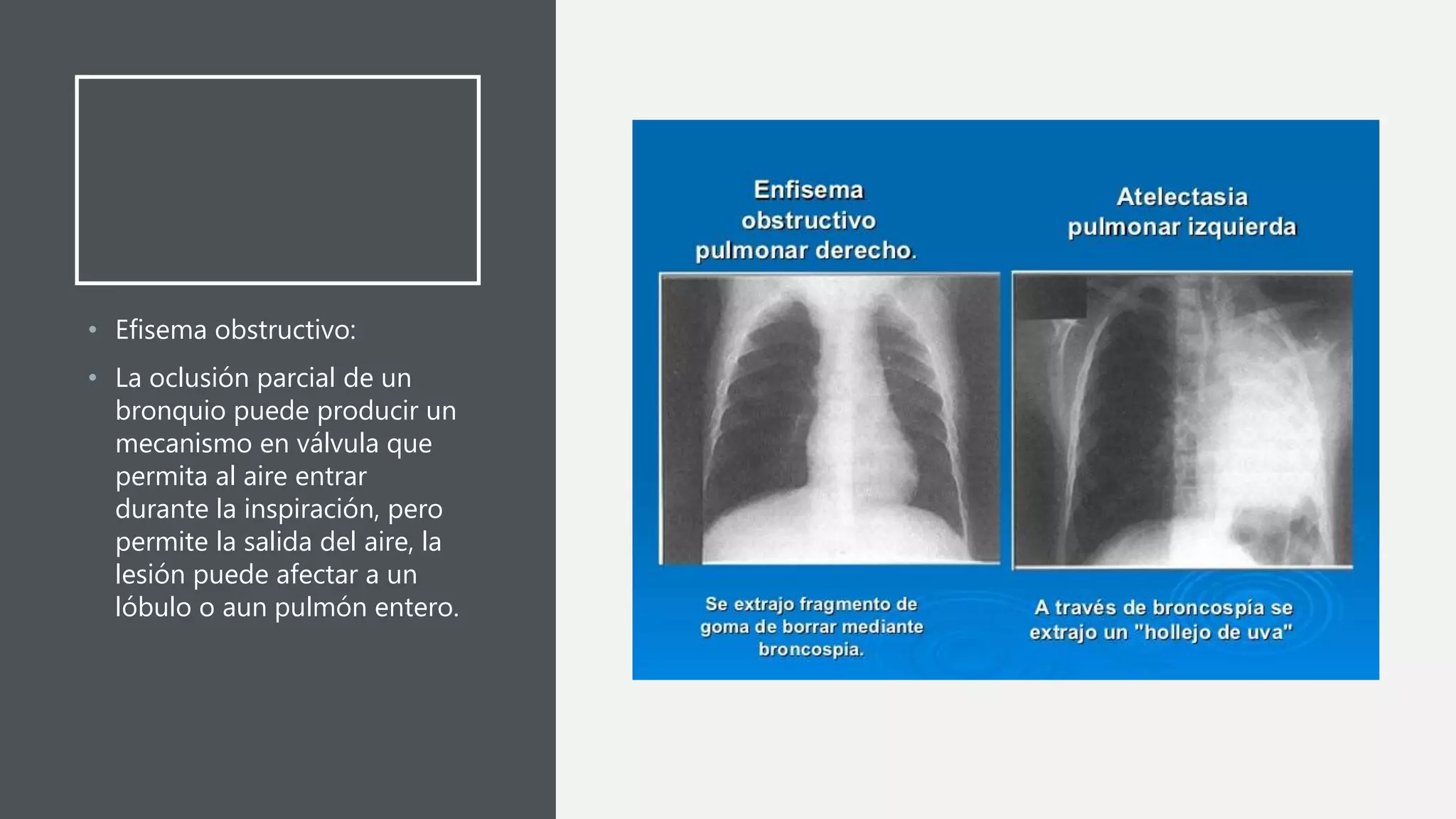 Pedrosa Radiologia e imagenologia El torax; hiperclaridad pulmonar ...