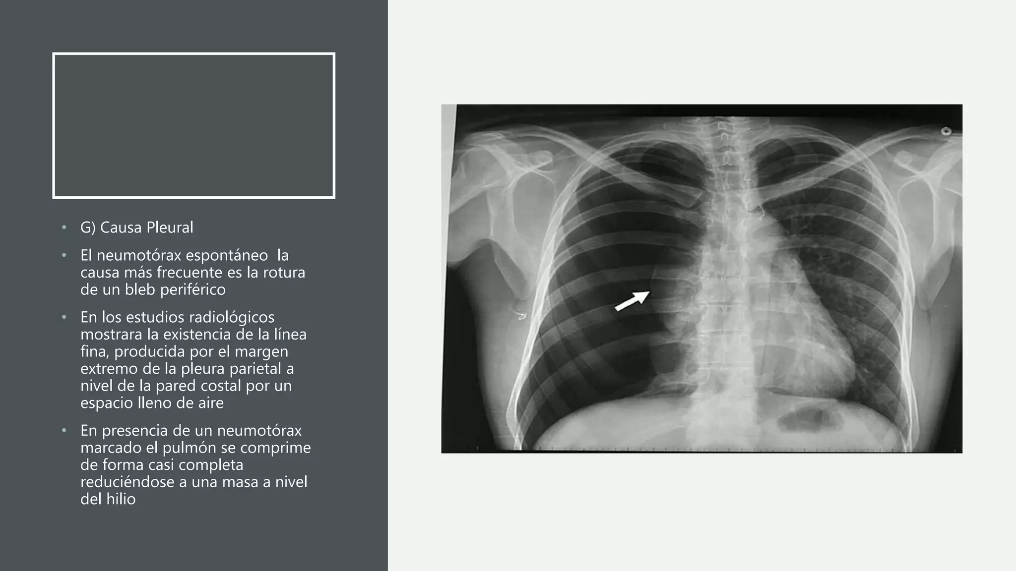 Pedrosa Radiologia e imagenologia El torax; hiperclaridad pulmonar ...