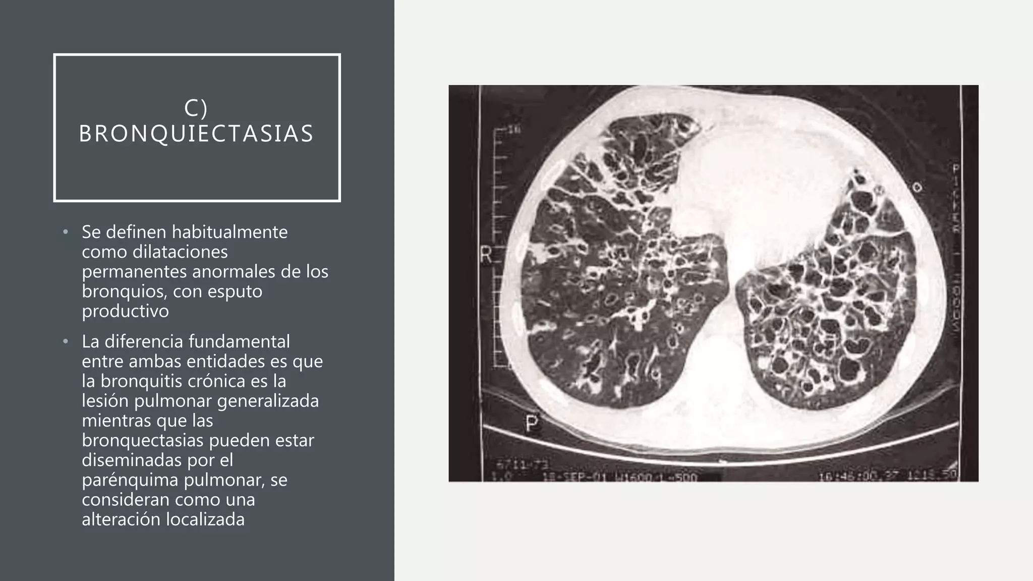 Pedrosa Radiologia e imagenologia El torax; hiperclaridad pulmonar ...