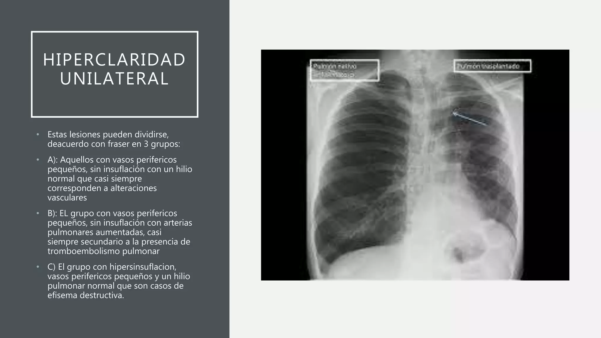 Pedrosa Radiologia e imagenologia El torax; hiperclaridad pulmonar ...