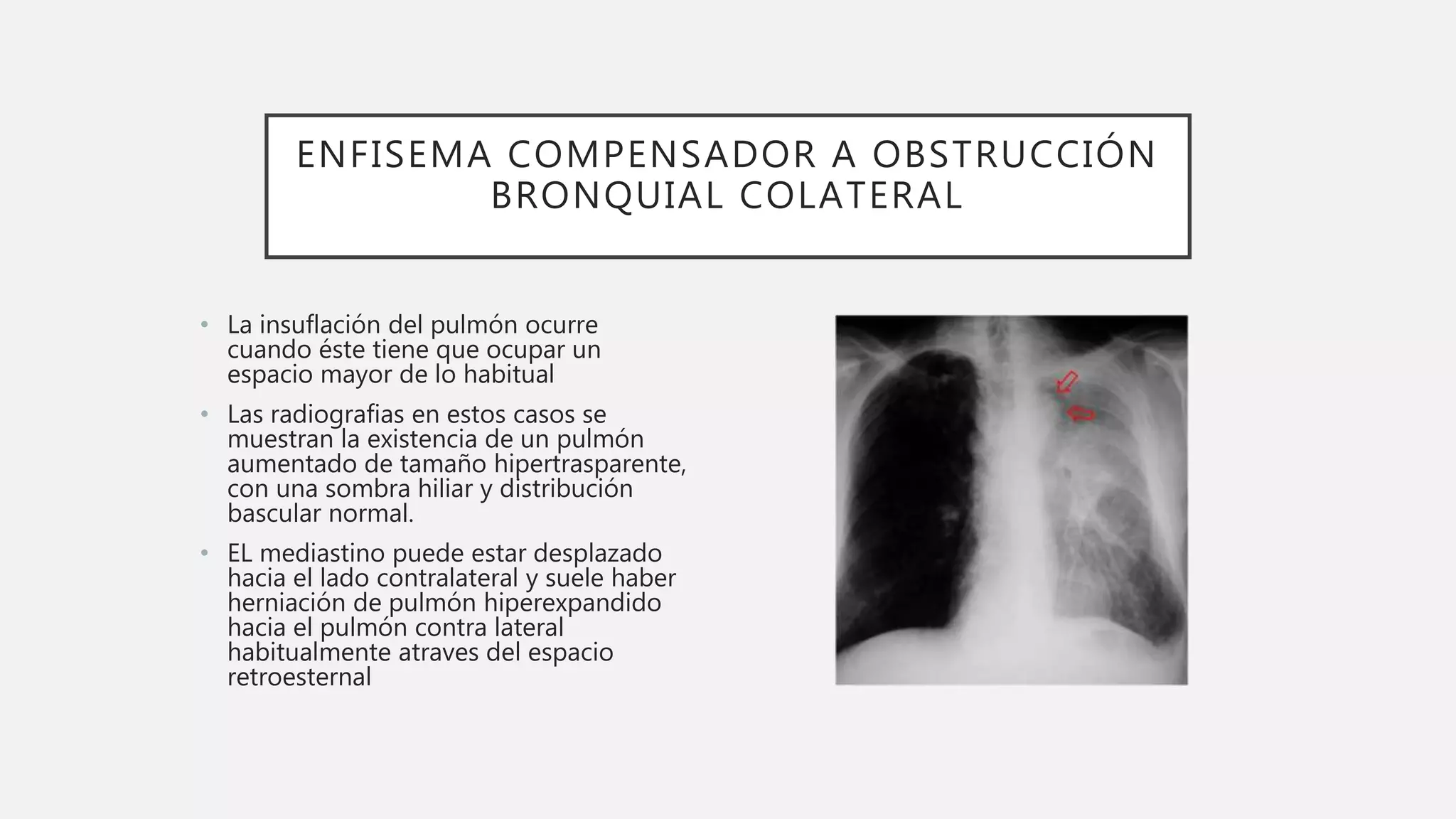 Pedrosa Radiologia e imagenologia El torax; hiperclaridad pulmonar ...