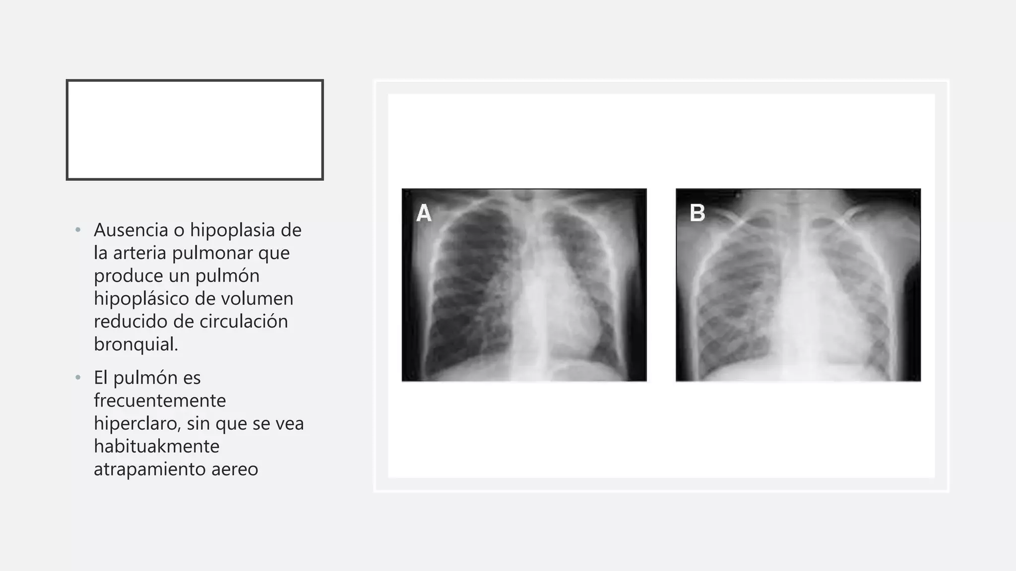 Pedrosa Radiologia e imagenologia El torax; hiperclaridad pulmonar ...