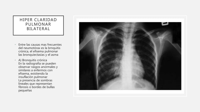 Pedrosa Radiologia e imagenologia El torax; hiperclaridad pulmonar ...