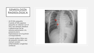 Pedrosa Radiologia e imagenologia El torax; hiperclaridad pulmonar ...