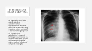 Pedrosa Radiologia e imagenologia El torax; hiperclaridad pulmonar ...