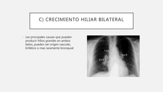 Pedrosa Radiologia e imagenologia El torax; hiperclaridad pulmonar ...