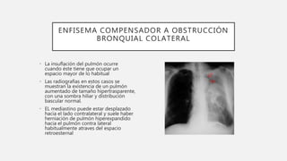 Pedrosa Radiologia e imagenologia El torax; hiperclaridad pulmonar ...