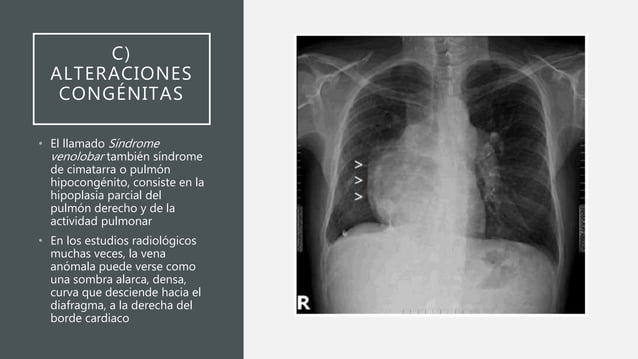 Pedrosa Radiologia e imagenologia El torax; hiperclaridad pulmonar ...