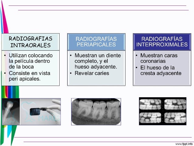 RadiografÍa Dental Pautas Enfermedades Y Tipos De RadiografÍas