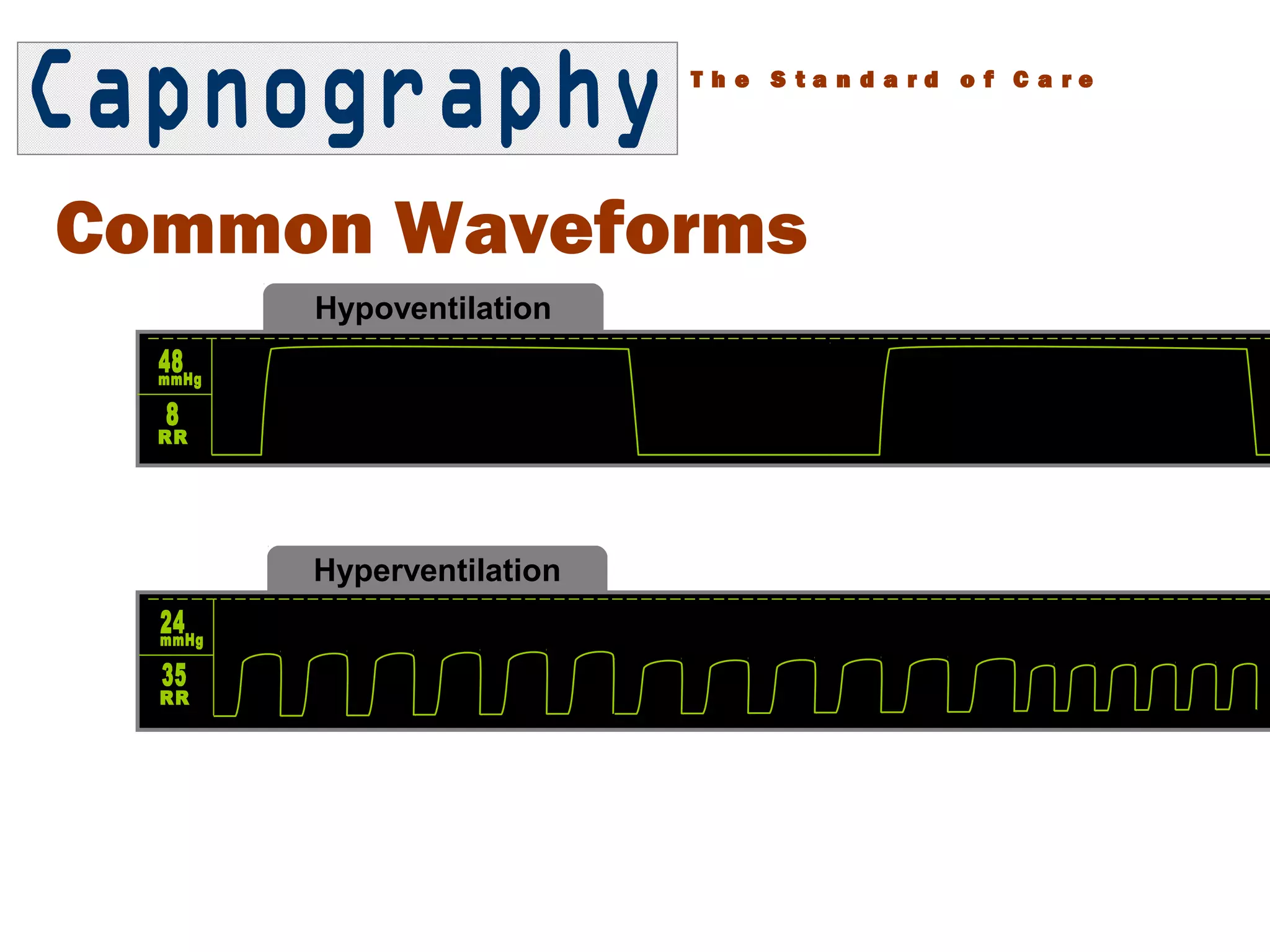 Capnography | PPT