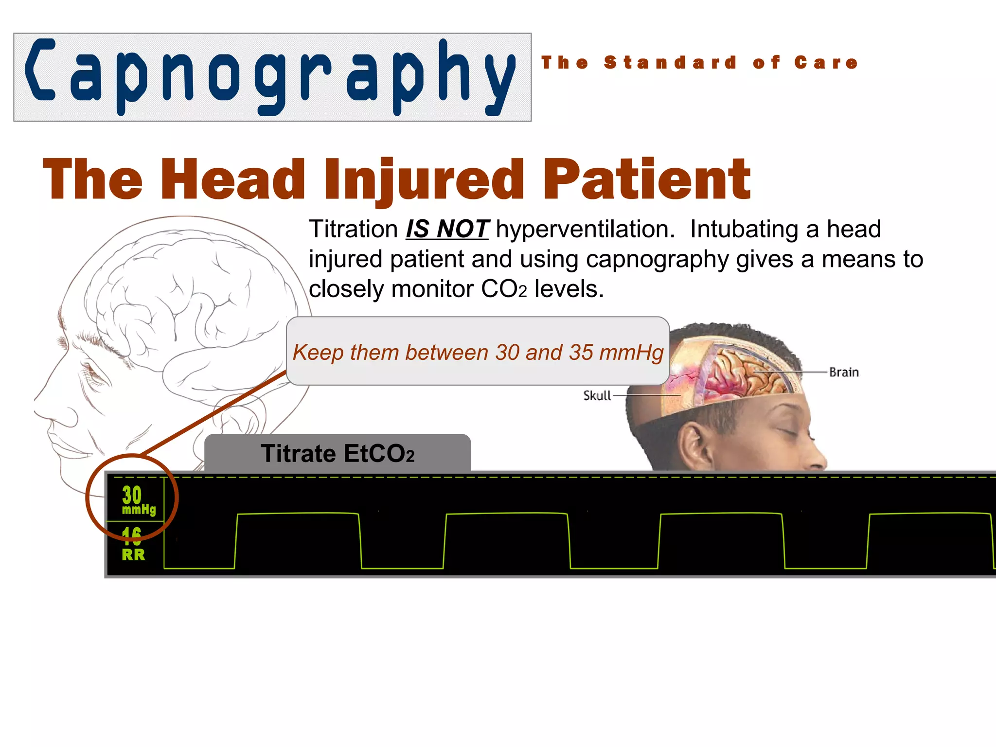 Capnography | PPT