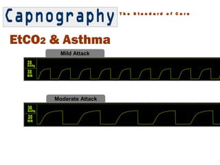 Capnography | PPT