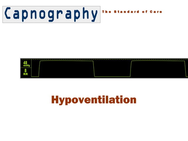 Capnography Ppt