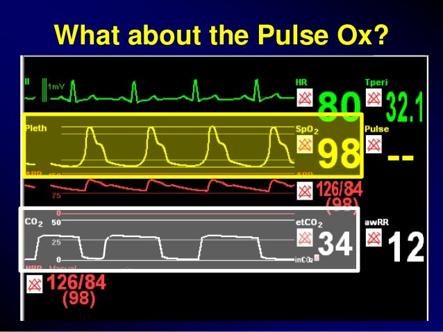 Capnography in icu