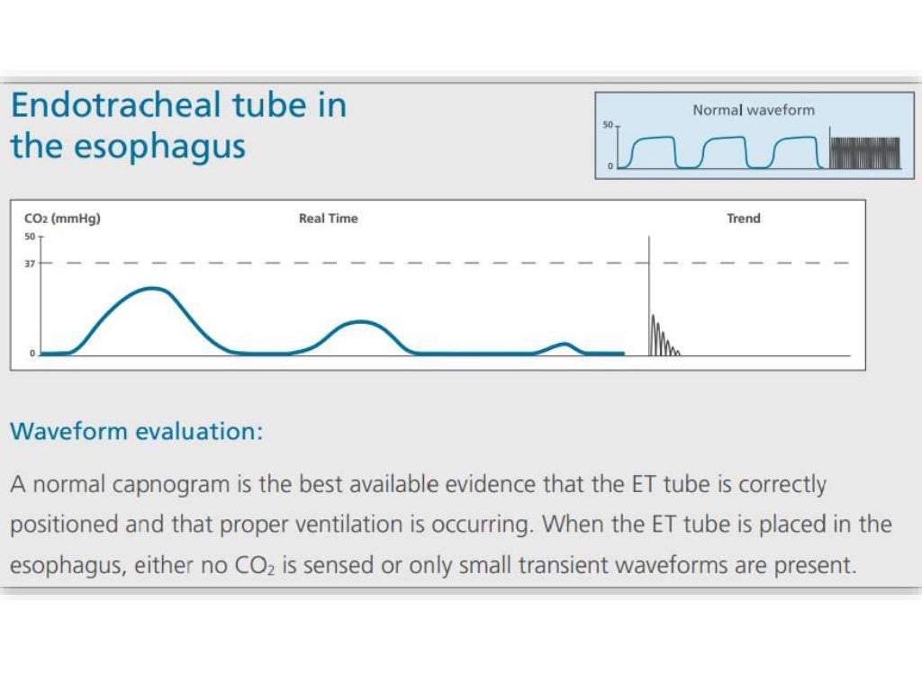 Capnography and interpretations | PPTX