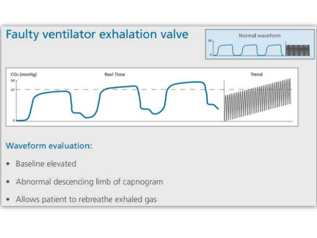 Capnography and interpretations | PPTX