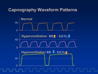 Capnography | PPT