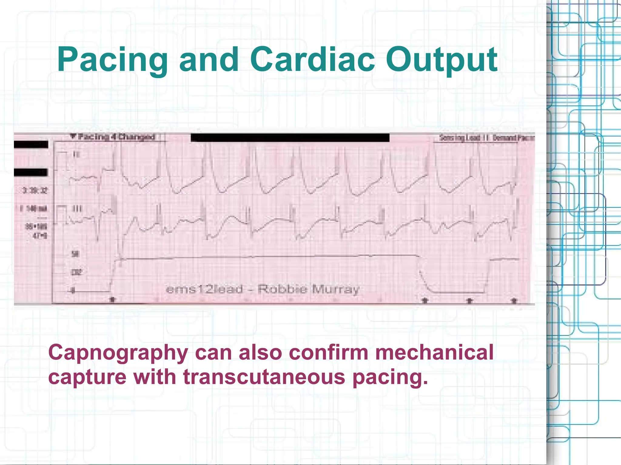 Prehospital Capnography | PPT