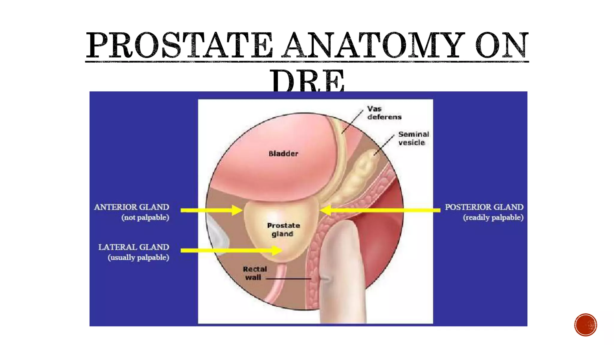 Carcinoma of prostate | PPTX